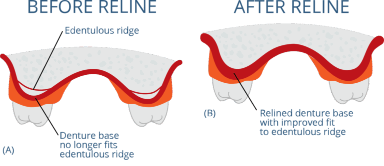 Denture Relines in Lethbridge, AB | Southern Denture Clinic